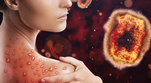 Maymun Çiçeği Virüsü Belirtileri Neler? Maymun Çiçeği Nasıl Bulaşır?